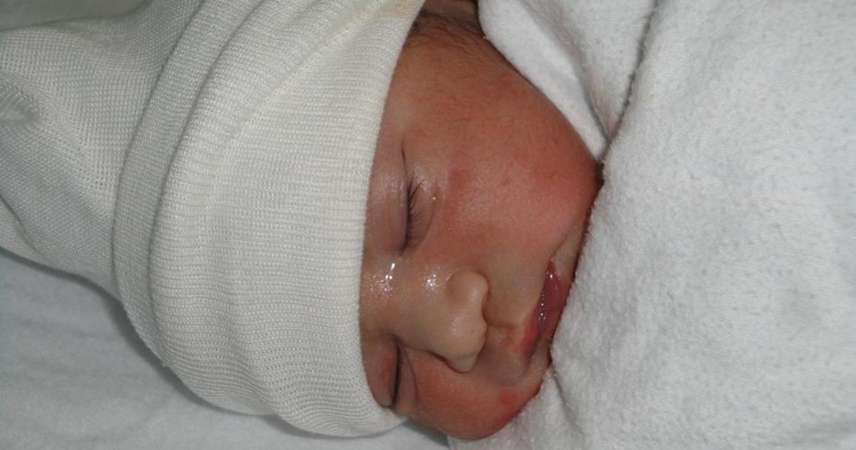 Skin Discoloration In Newborns: What It Usually Means | BabyGaga